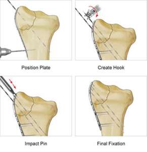 Radial Column Pin Plate™ – TriMed Inc.