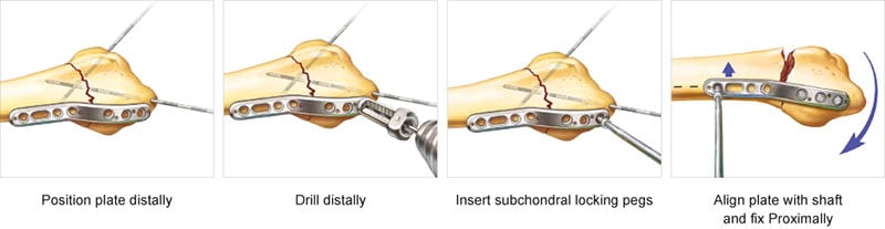 Radial Column Peg Plate – TriMed Inc.