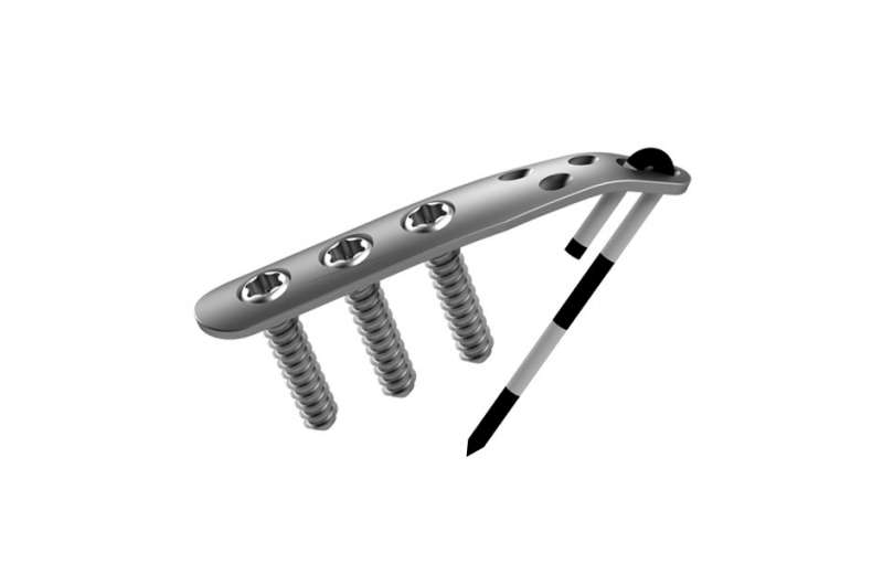 Wrist Fixation System – TriMed Inc.