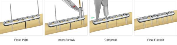 Forearm Plates – TriMed Inc.