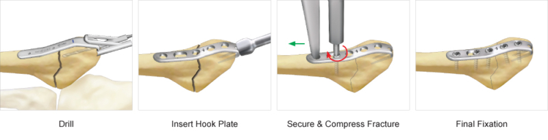 Fifth Metatarsal Hook Plate™ – TriMed Inc.
