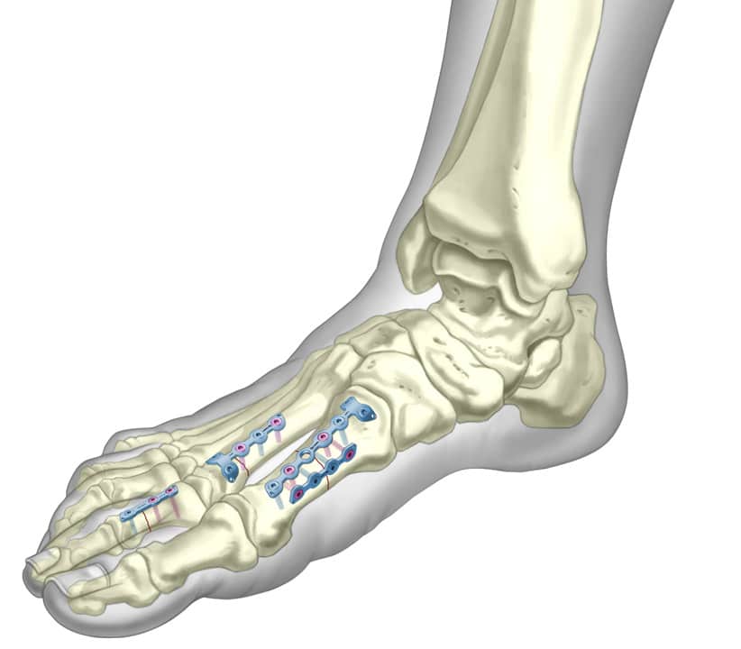 Distal Xtremities Plates – TriMed Inc.